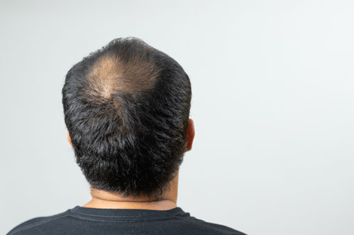 Male Pattern Hair Loss (Androgenetic Alopecia) - Good Skin Dermatology